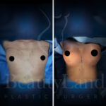 Miami Plastic Surgery Photo Gallery