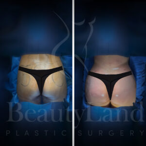 Miami Plastic Surgery Photo Gallery - Beautyland Plastic Surgery